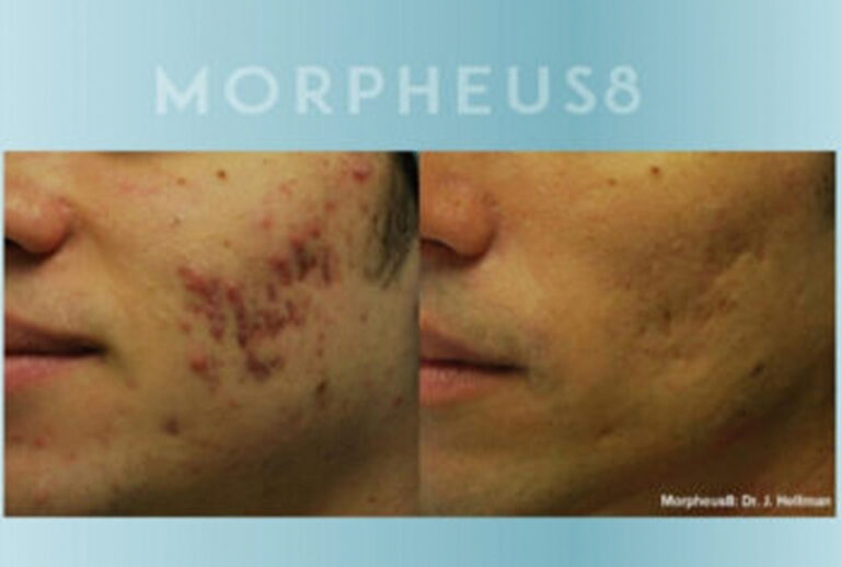 Morpheus8 Rf Microneedling Palo Alto Ca Palo Alto Laser And Skin Care